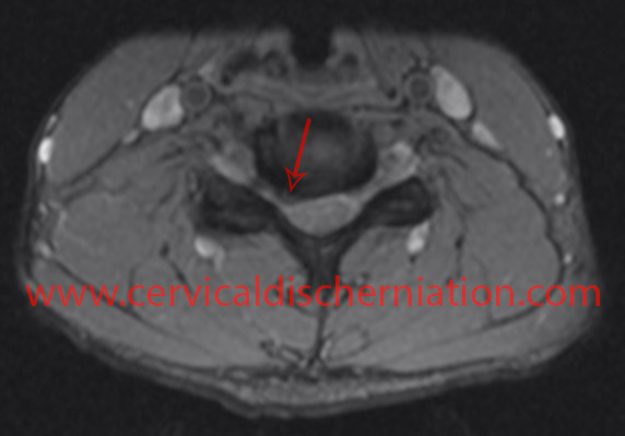 Cervical Disc Herniation